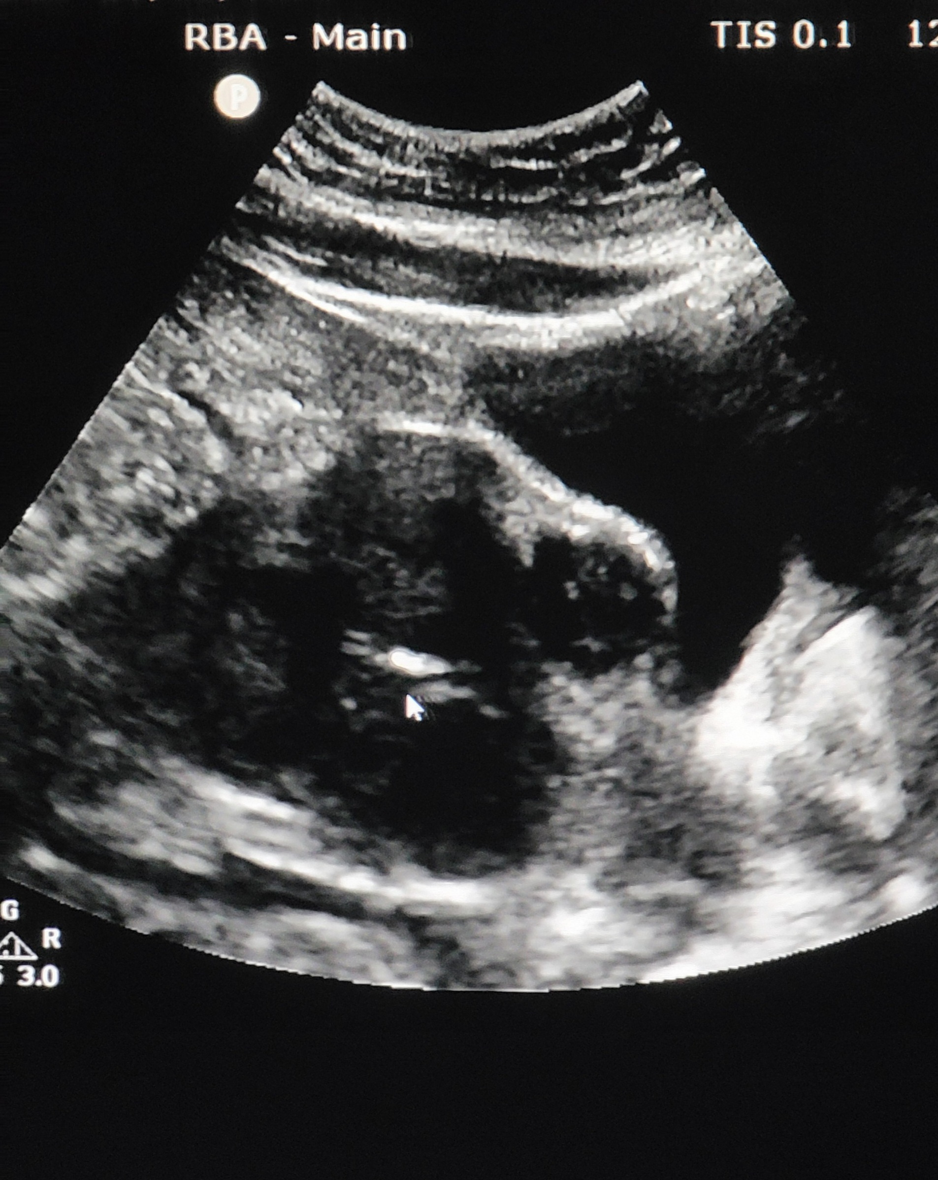 Continue IVF for a rainbow baby after miscarriage - Gift of Parenthood